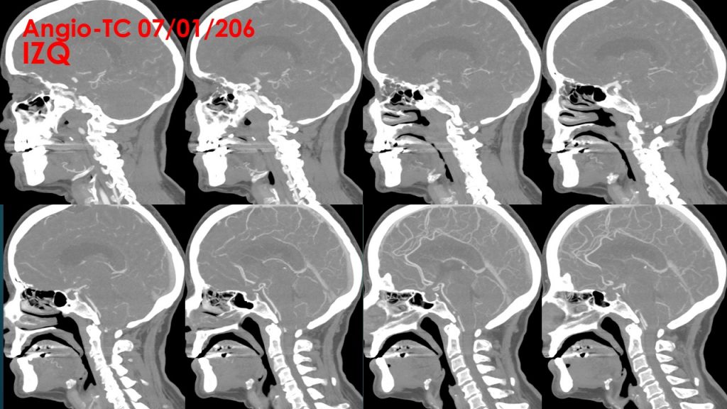 Caso Mayo 2018 - GeNI: SOCIEDAD DEL GRUPO ESPAÑOL DE NEURORRADIOLOGÍA ...